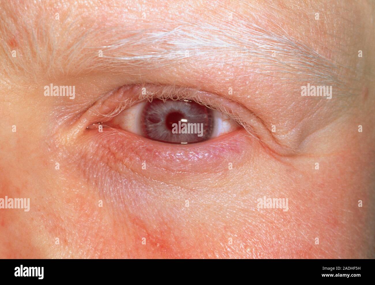 Albinism. Close-up of the eye of a 37-year-old woman with albinism ...