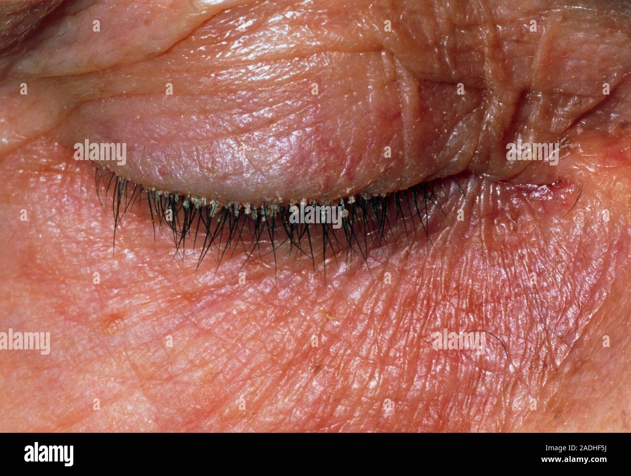 Blepharitis View Of An Inflamed Upper Eyelid Of A 79 Year Old Woman
