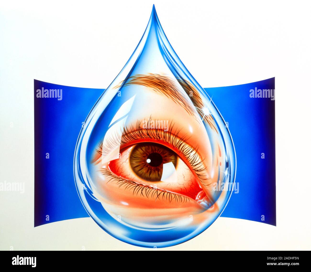 Conjunctivitis. Artwork of an inflamed eye with conjunctivitis ...