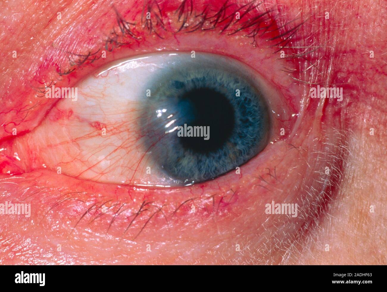 Pterygium. View of the eye of a 50 year old woman showing an overgrowth ...