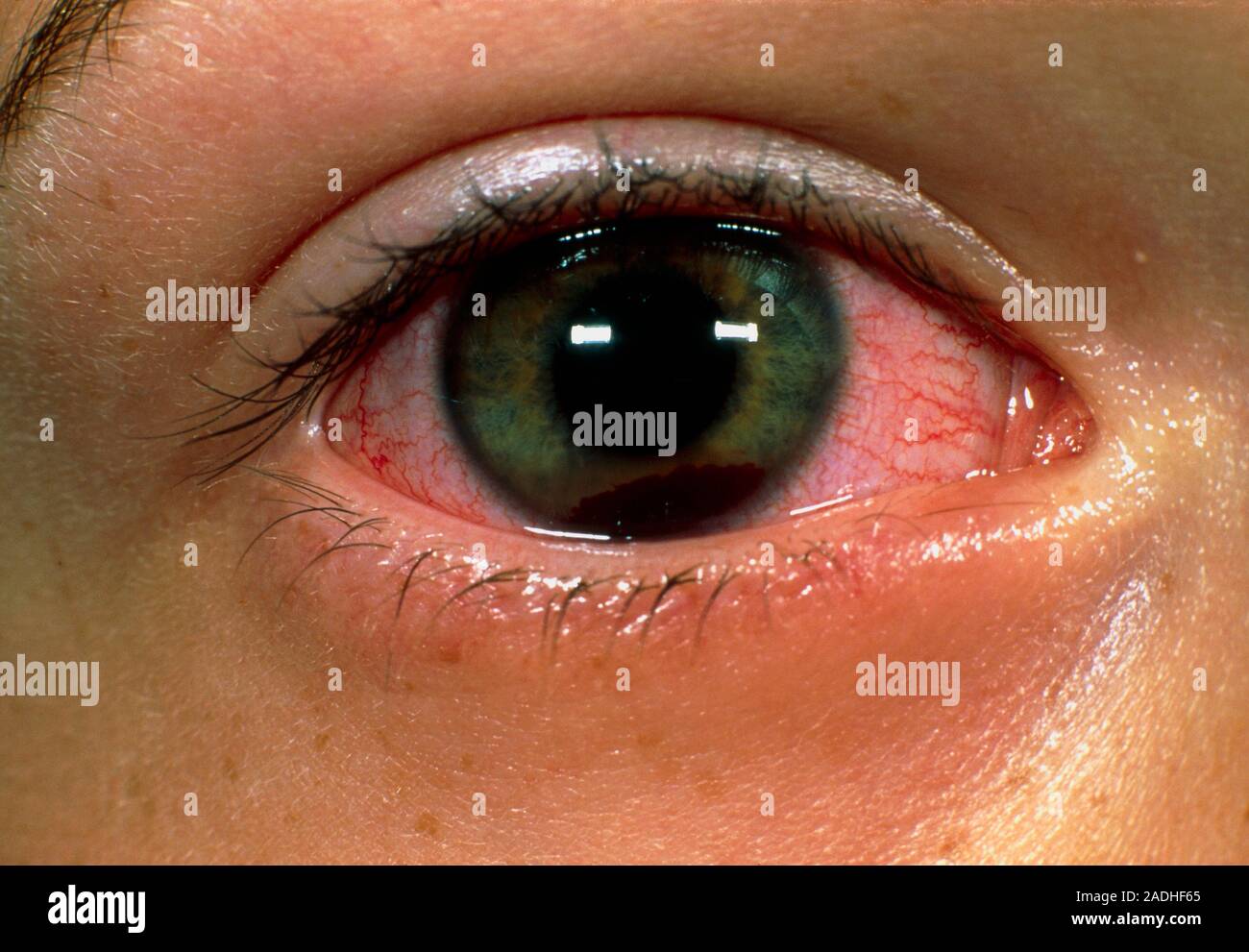 Hyphaema. View of the eye of a patient suffering from hyphaema ...