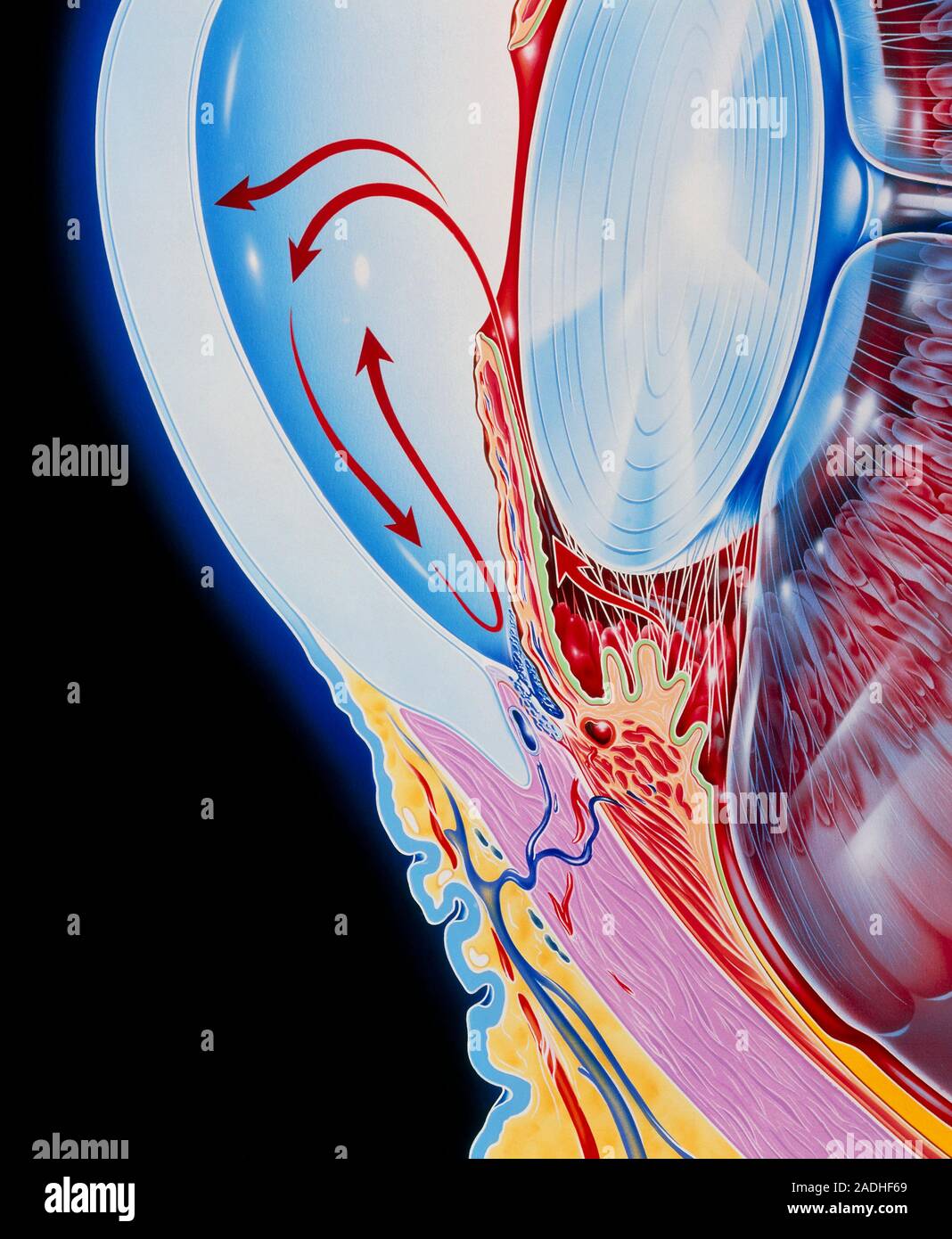 Glaucoma. Illustration showing flow of aqueous humour (red arrows) in ...