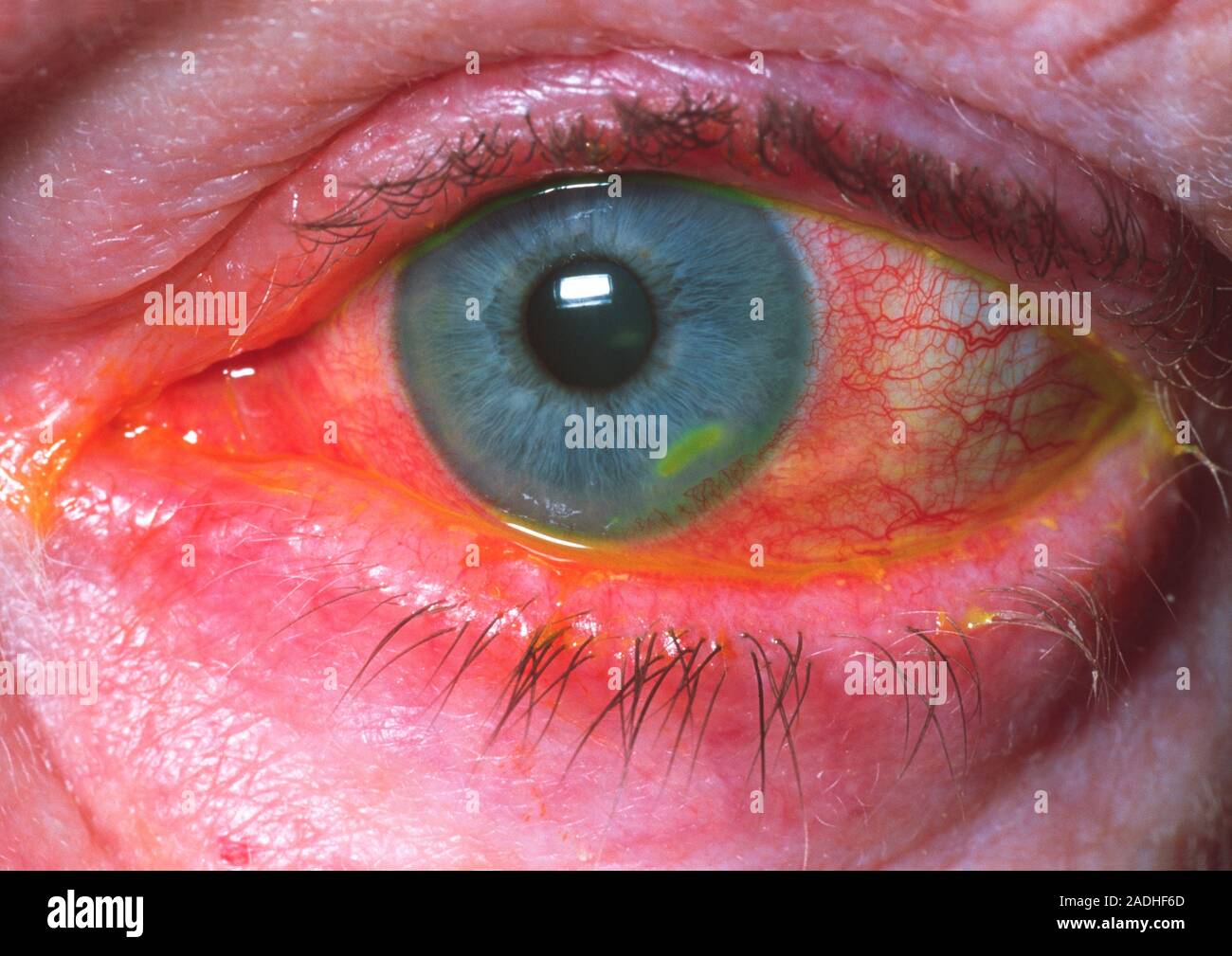 Keratitis. Close-up of the eye of a 64-year-old woman suffering from ...