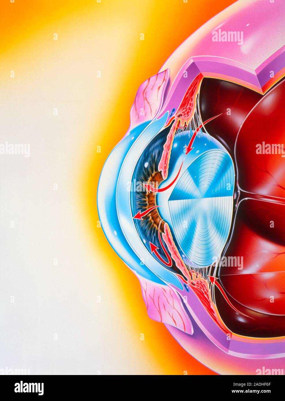 Glaucoma. Artwork showing the flow of the watery aqueous humour (arrows ...