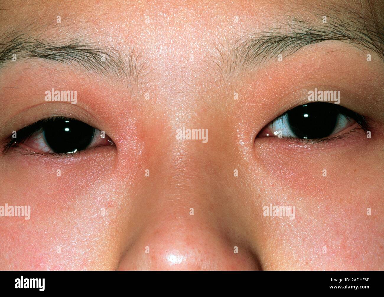 Allergic conjunctivitis. Eyes of a 14-year-old girl with allergic ...