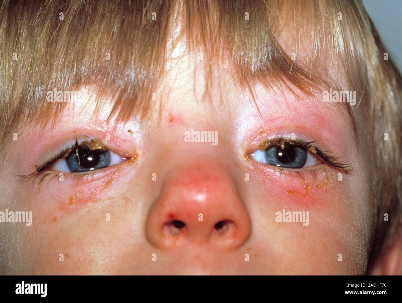 Conjunctivitis. Face of a two year old boy showing his inflamed and ...