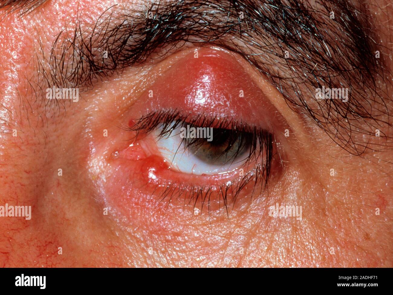 Inflamed eyelids of a 50 year old man caused by meibomitis, a disorder ...