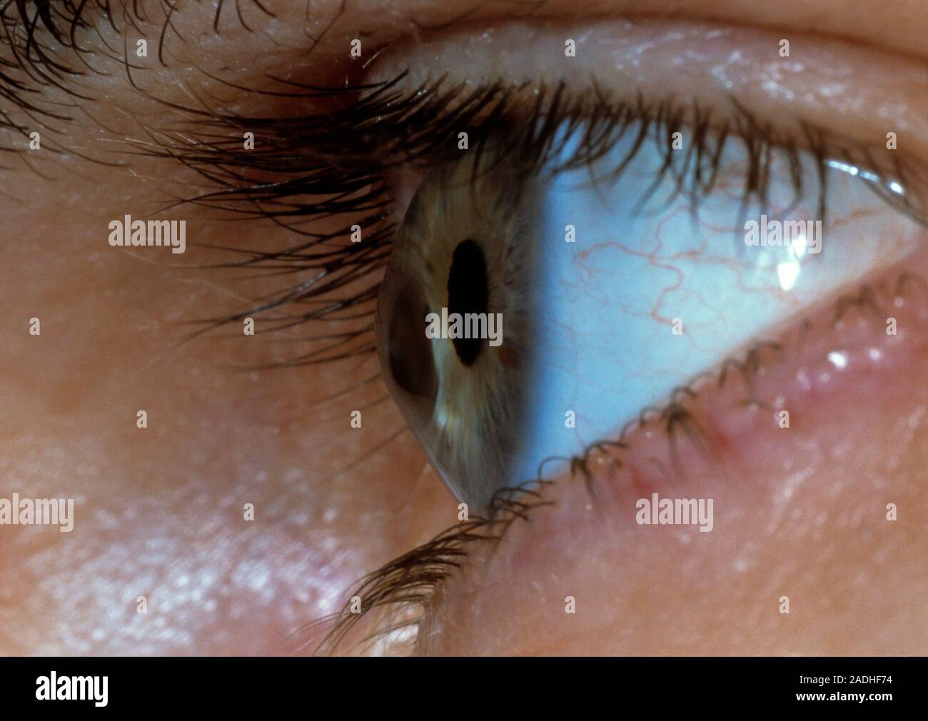 Keratoconus. Close-up of the eye of a 29-year-old man with keratoconus ...