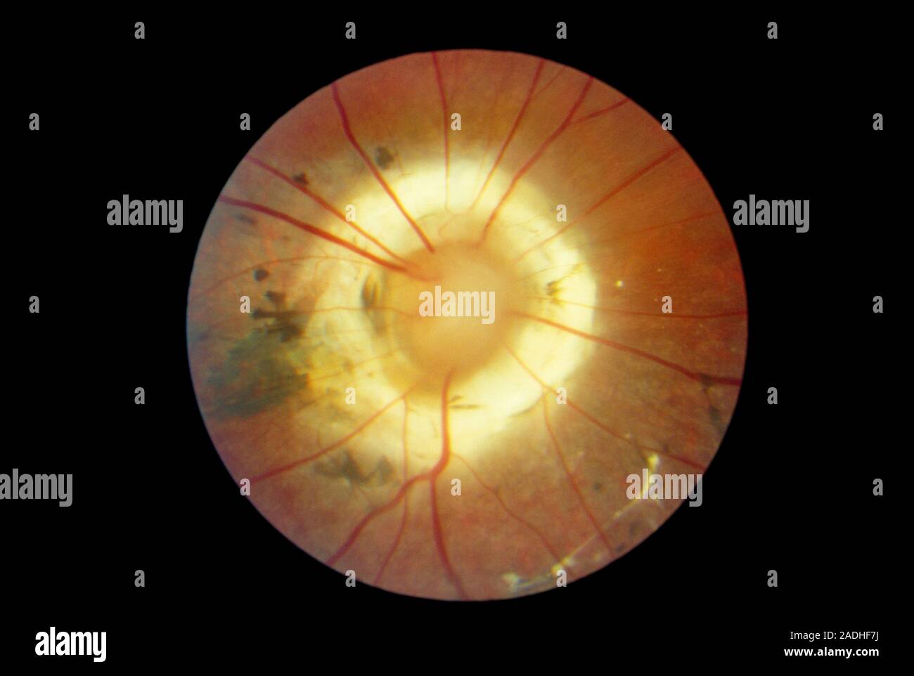 Glaucoma. Ophthalmoscope view of the retina of an eye showing glaucoma ...