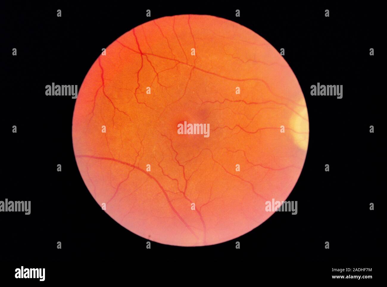 Macular hole on the retina of the eye, ophthalmoscope image. The hole ...