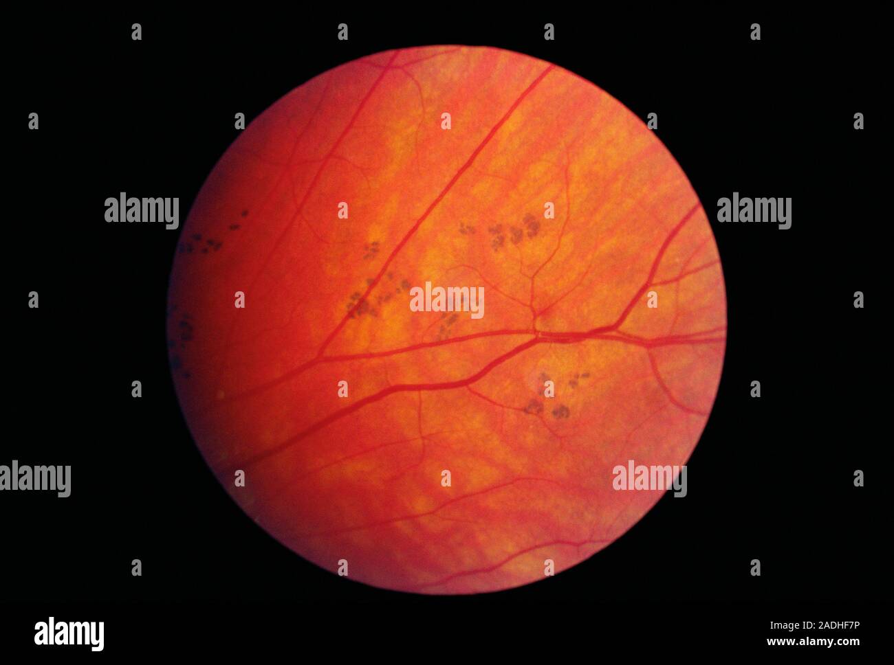 Bear tracks on the retina of the eye, ophthalmoscope image. The bear ...