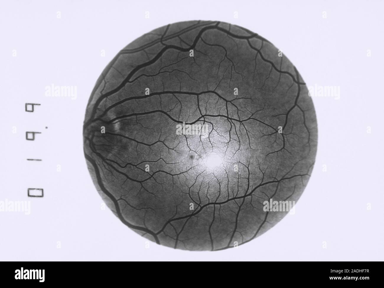 Retinal blood vessel disorder. Image 1 of 4. Fluorescein angiogram of a ...