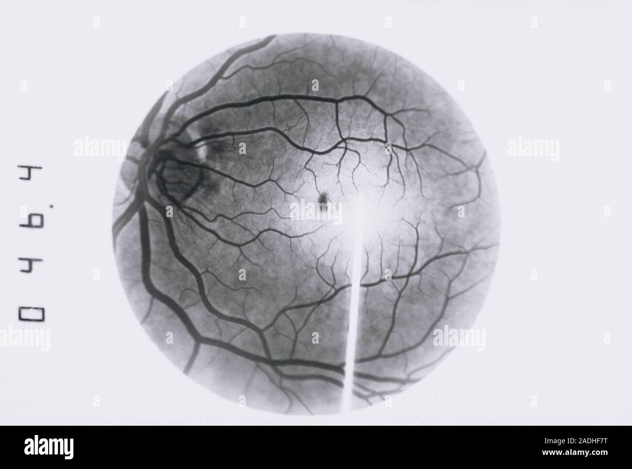Retinal blood vessel disorder. Image 2 of 4. Fluorescein angiogram of a ...