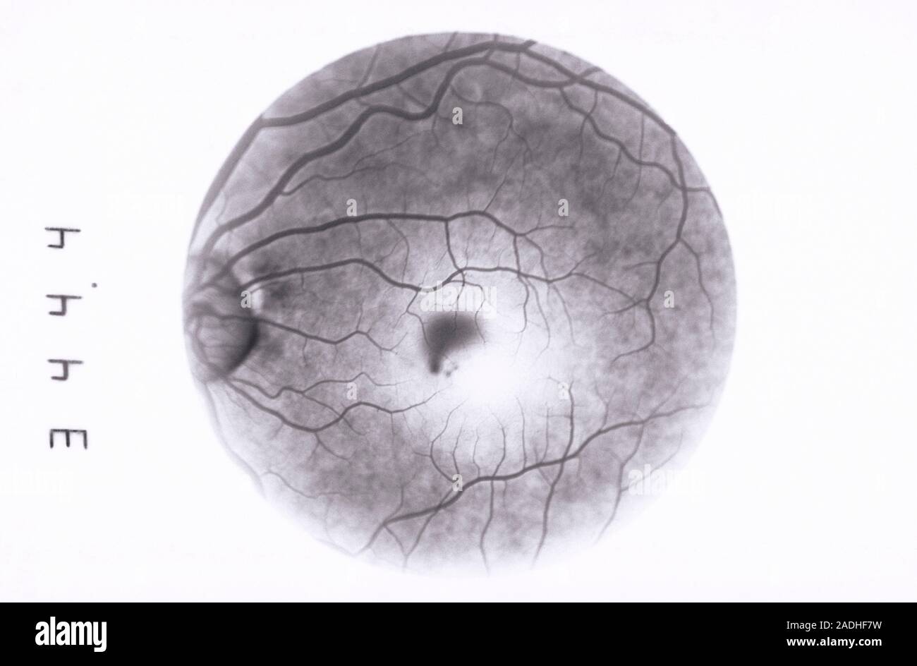 Retinal blood vessel disorder. Image 4 of 4. Fluorescein angiogram of a ...
