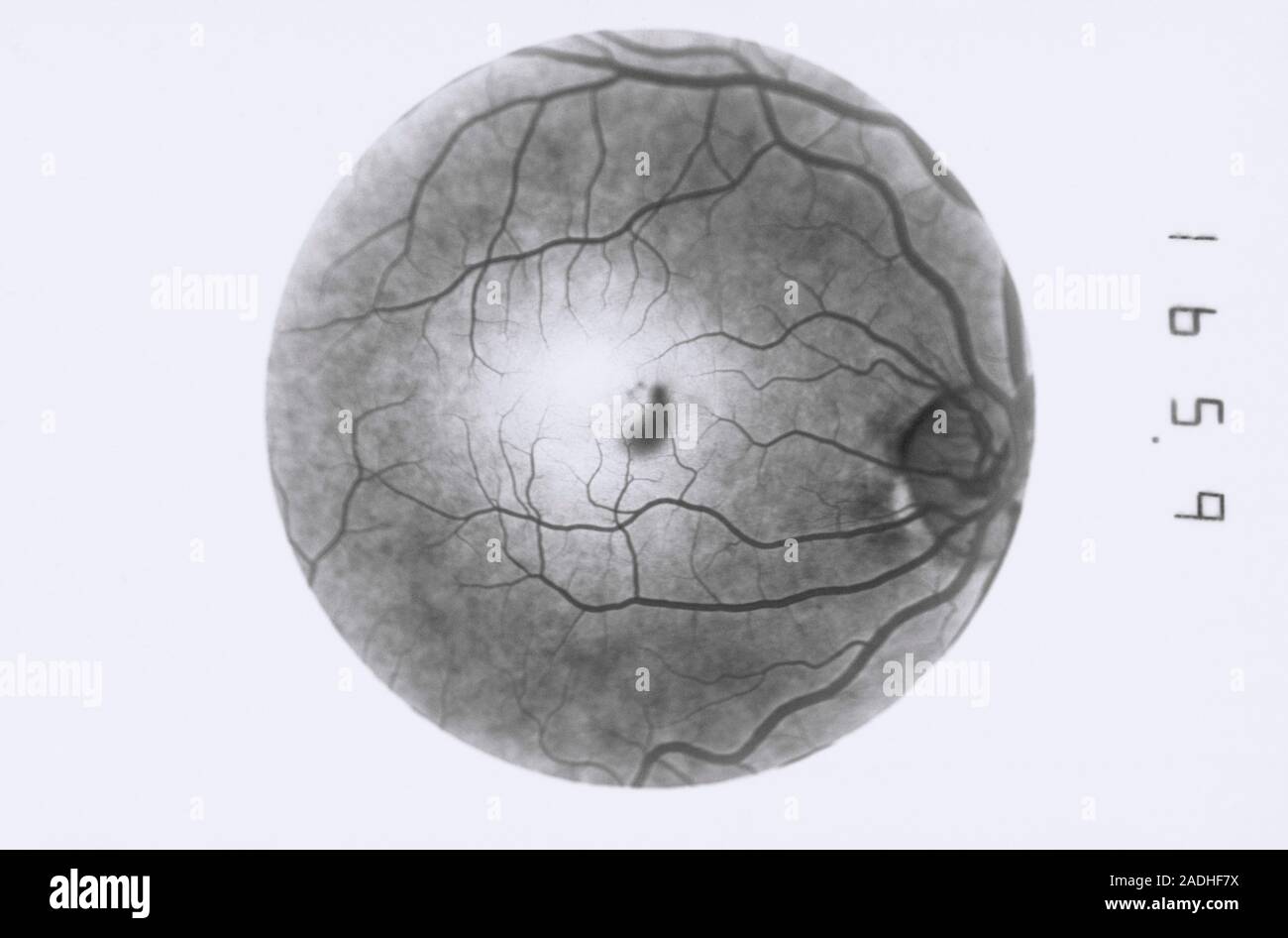 Retinal blood vessel disorder. Image 3 of 4. Fluorescein angiogram of a ...