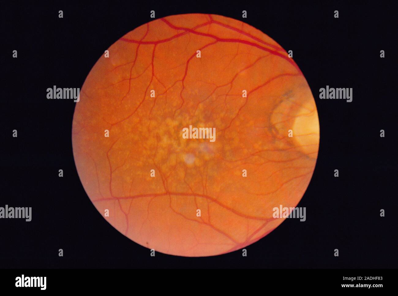 Macular degeneration, ophthalmoscope image. Numerous yellow drusen ...