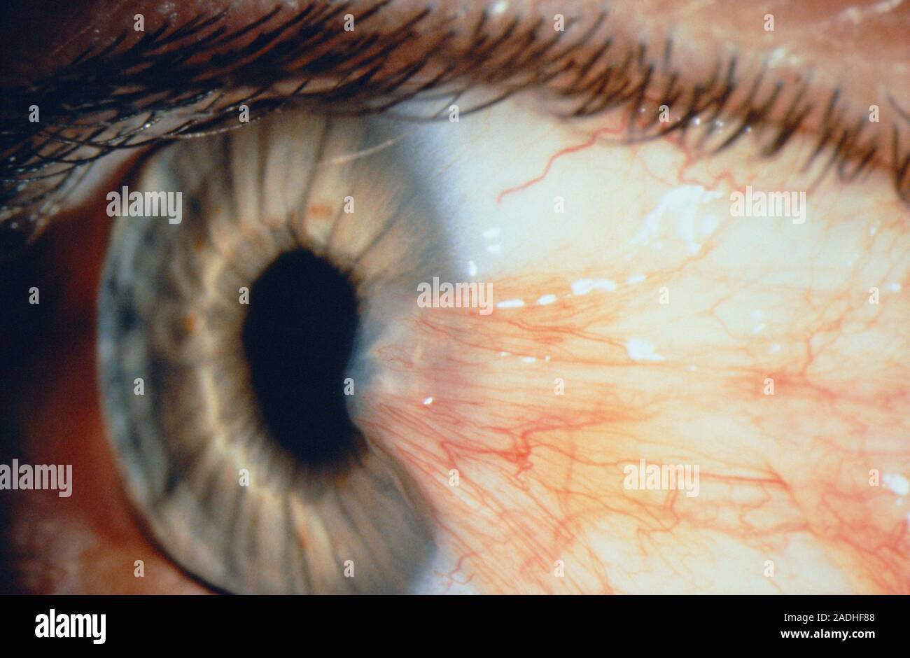 Pterygium. Eye of a patient showing an overgrowth on the cornea known ...