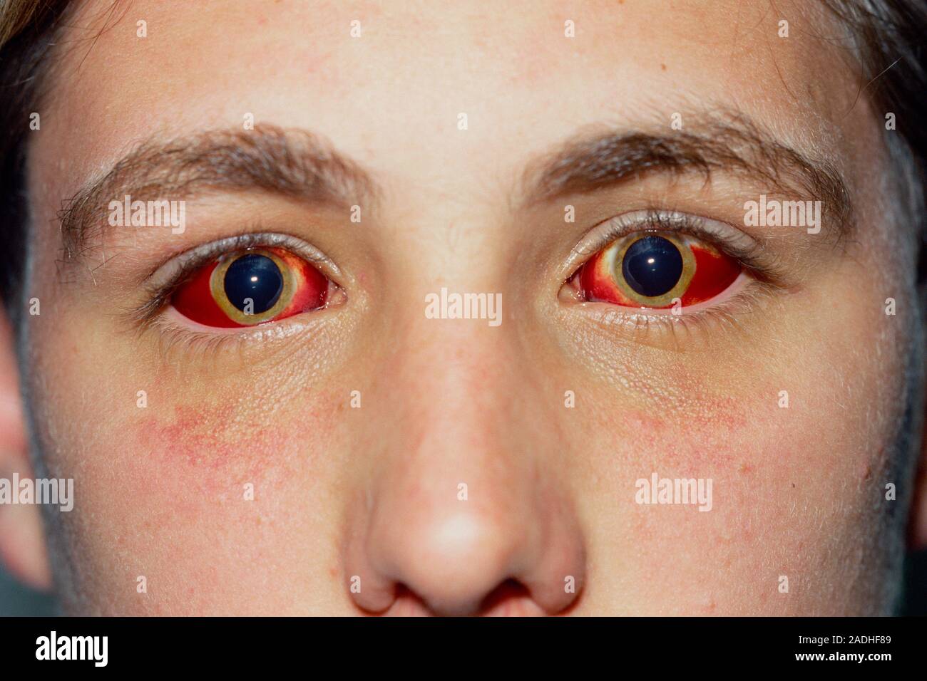 Haemorrhaged eyes. Bloody eyes of a patient suffering from sub ...