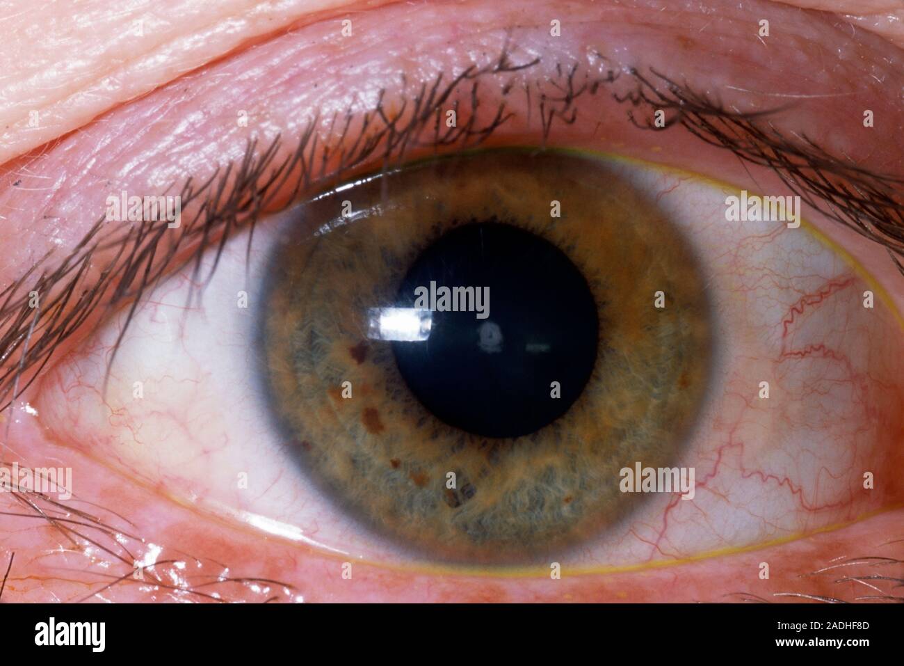 Congenital cataract (present at birth) in the eye of a 40-year-old ...