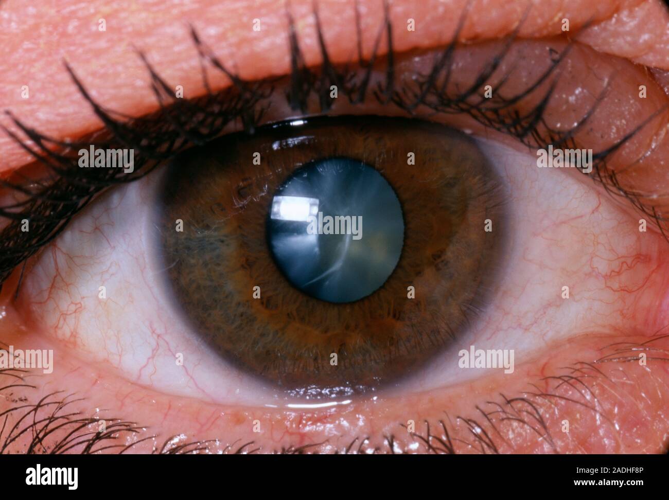 Cataract in the eye of a 46-year-old woman. The cataract is the large ...