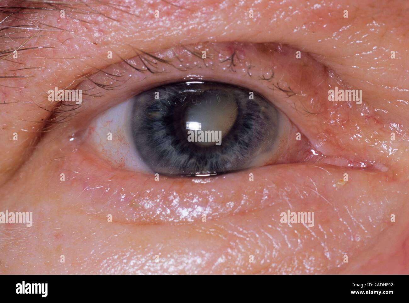Cataract (grey) in the eye of a 56 year old man. Cataract is a ...