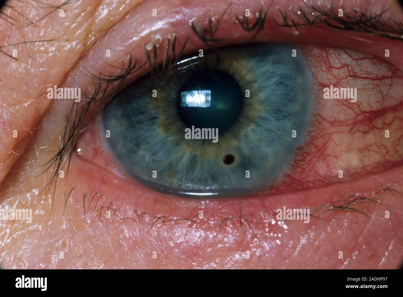 Foreign body in eye. Image 1 of 2. Small foreign body (black, below ...