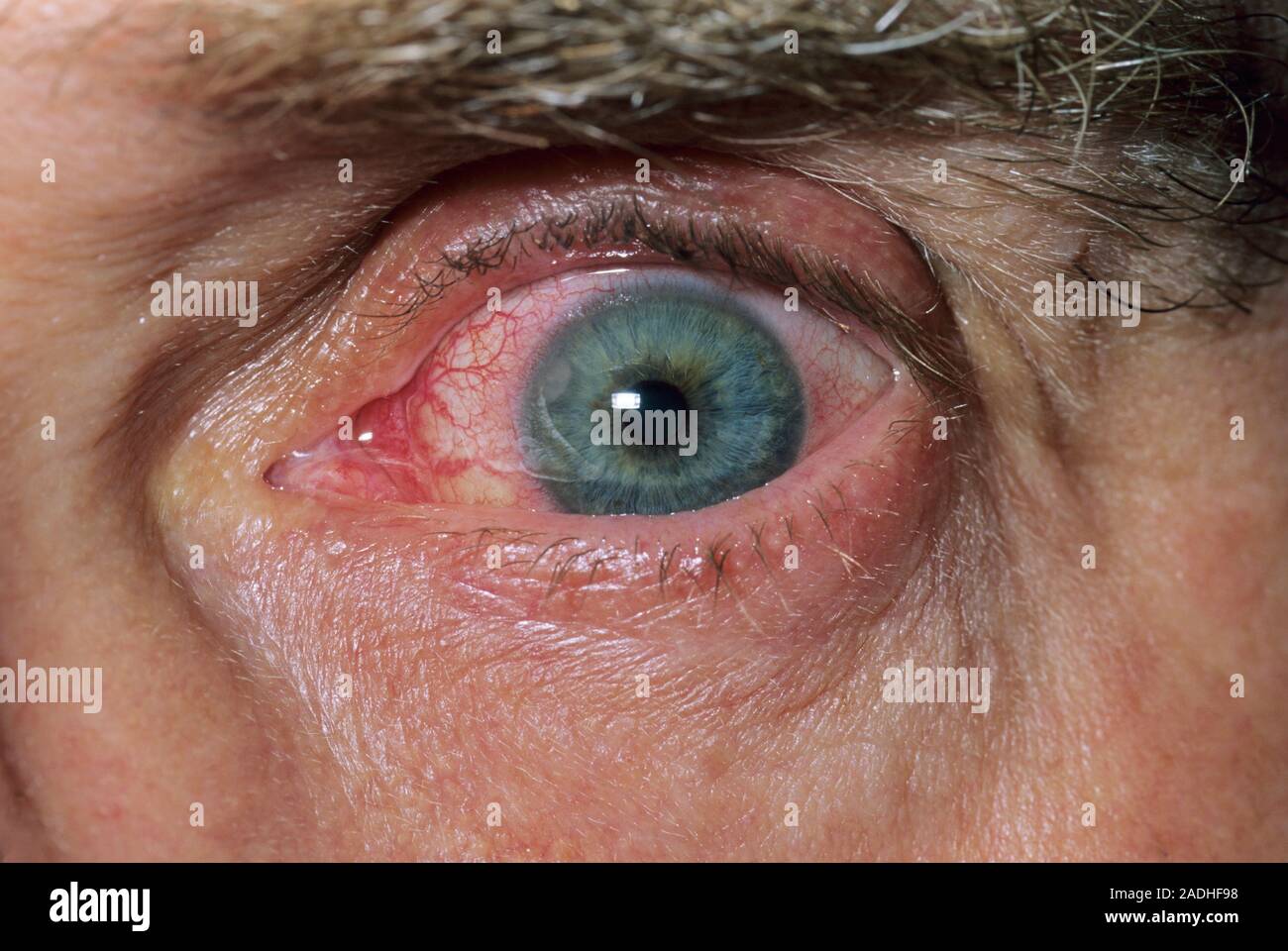 Corneal infection in the eye of a 55-year-old man. The cornea is the ...
