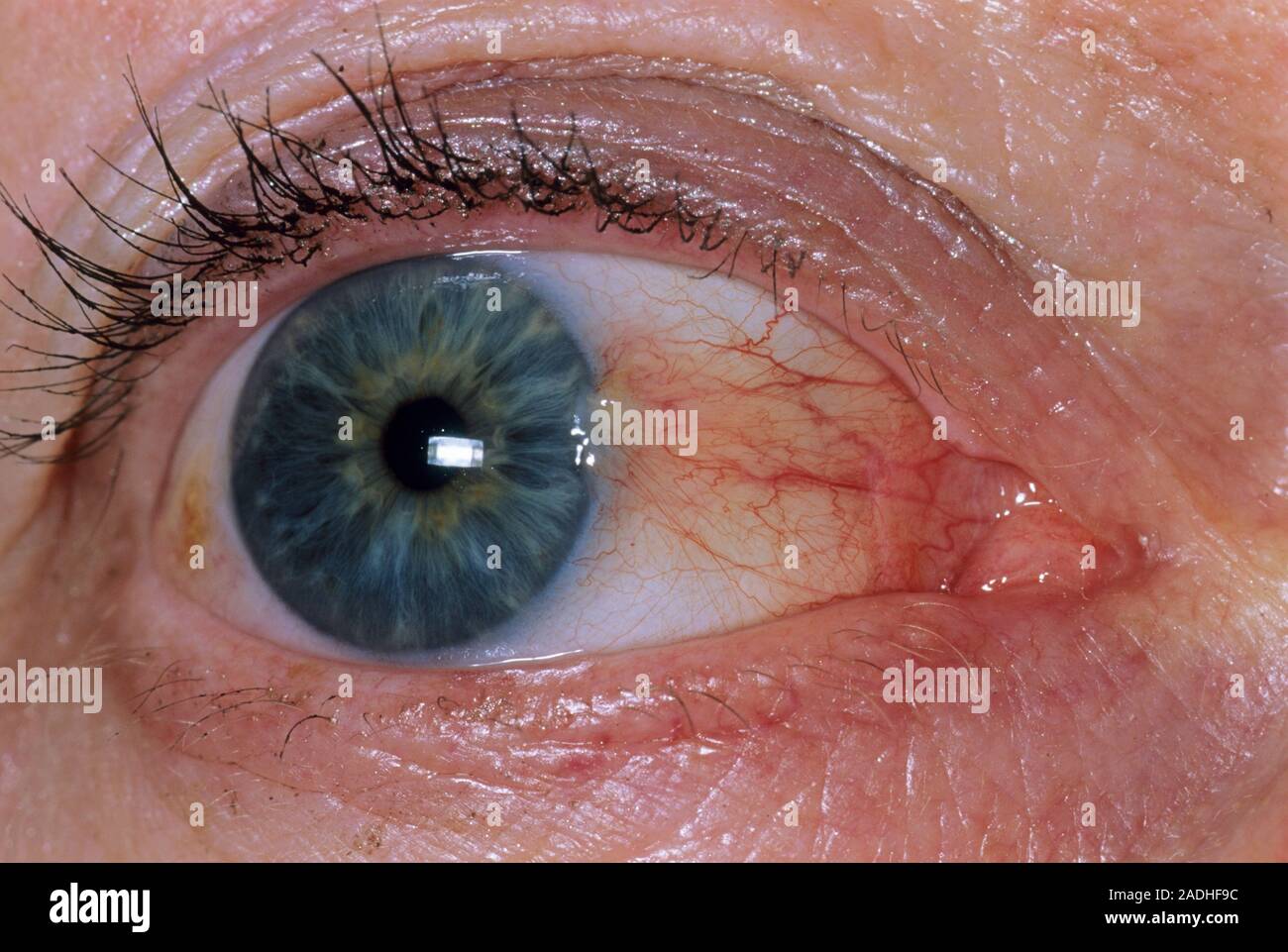 Pterygium in the eye of a 57-year-old womman. Pterygium is an ...