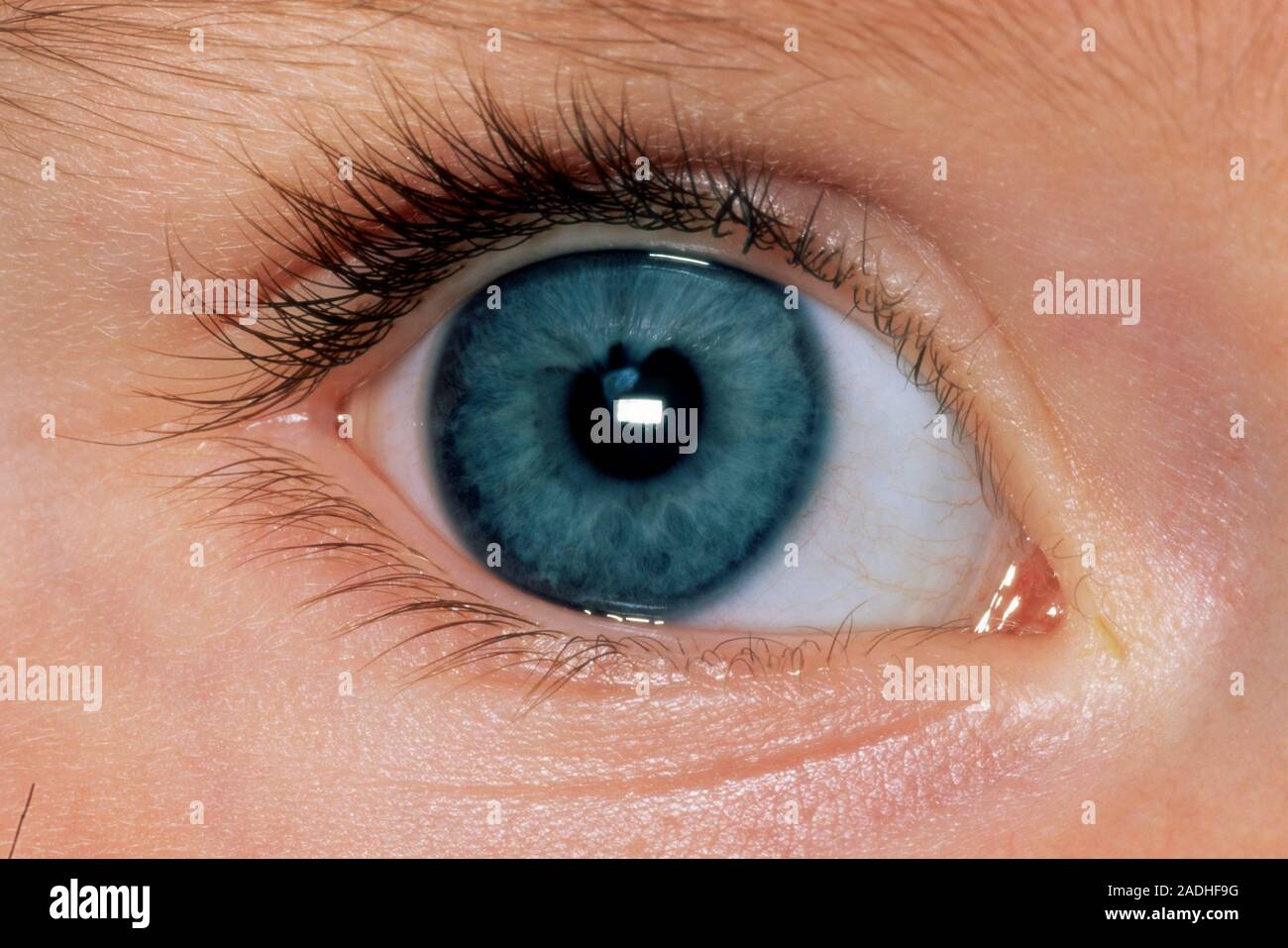 Distorted iris. One-year-old girl with a distorted iris caused by ...