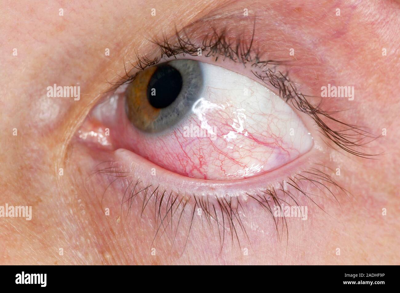 Inflamed white of the eye. Eye of a female patient with episcleritis ...