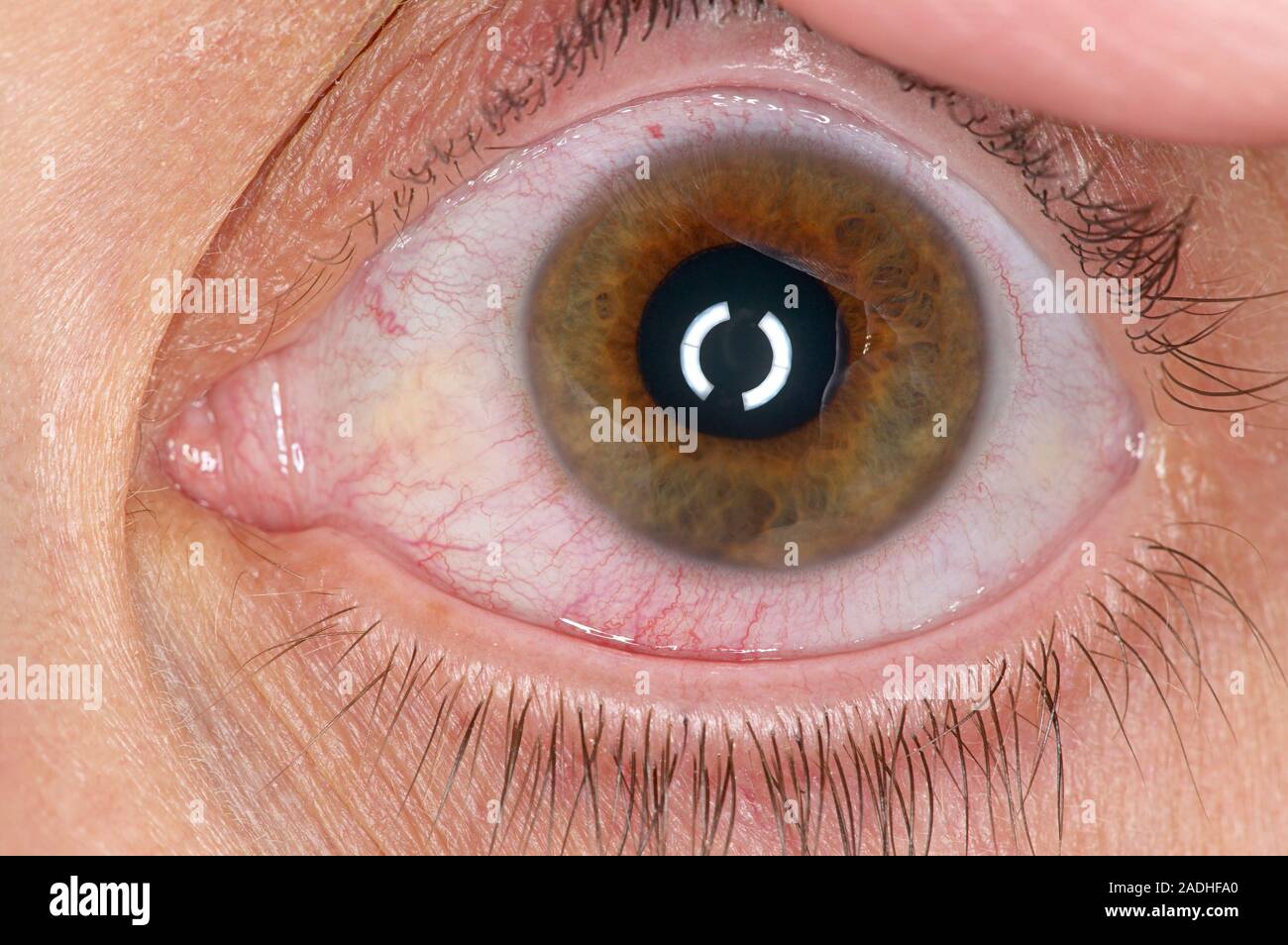 Iritis, inflammation of the iris (brown) of the eye. This is an early ...