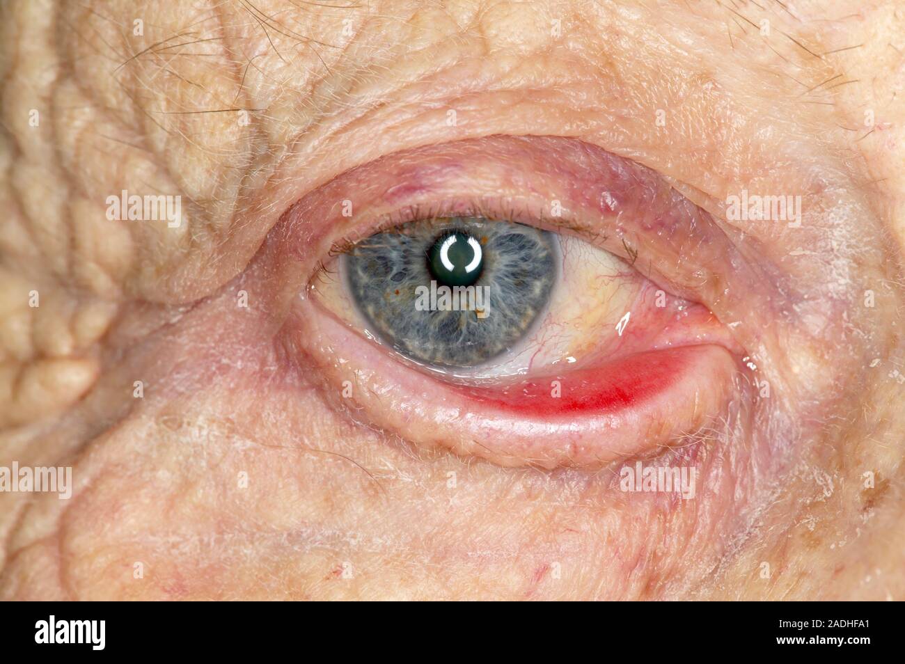 Ectropion (drooping eyelid) of the eye. The drooping is caused by a ...