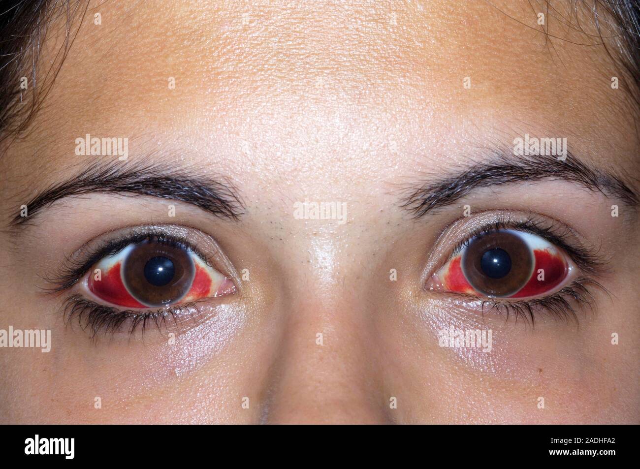 MODEL RELEASED. Bleeding in the eyes. 16 year old girl with bleeding in ...