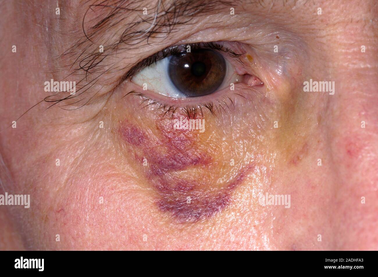 Post-op bruising of the eyelid. Bruised lower eyelid of a 75 year old ...