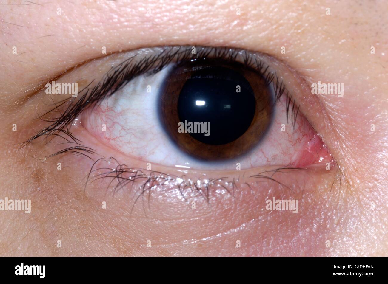 Dilated pupil. 30 year old woman with a dilated pupil. She mistakenly ...