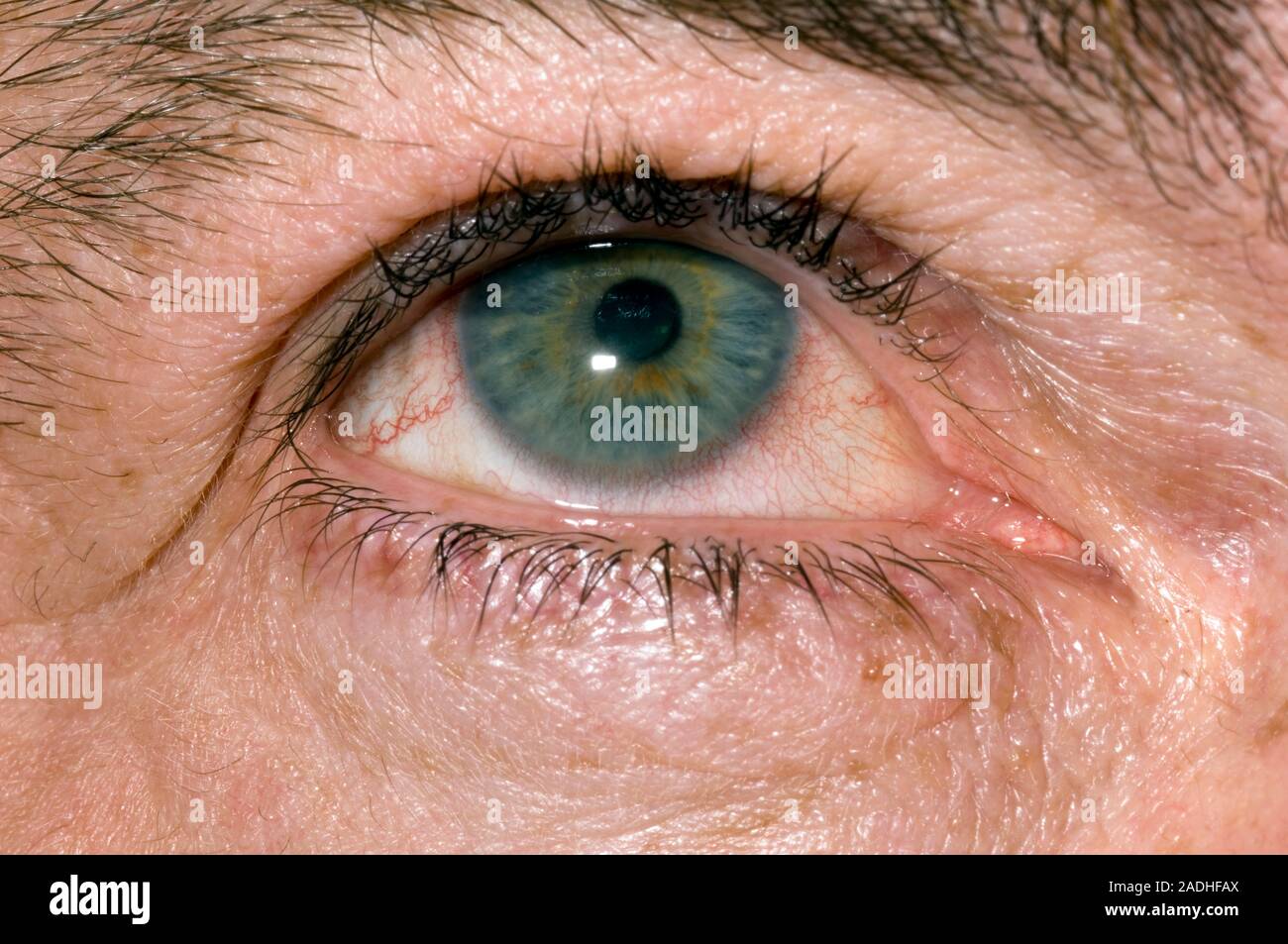 MODEL RELEASED. Inflamed iris. Bloodshot eye of a 50 year old man with ...