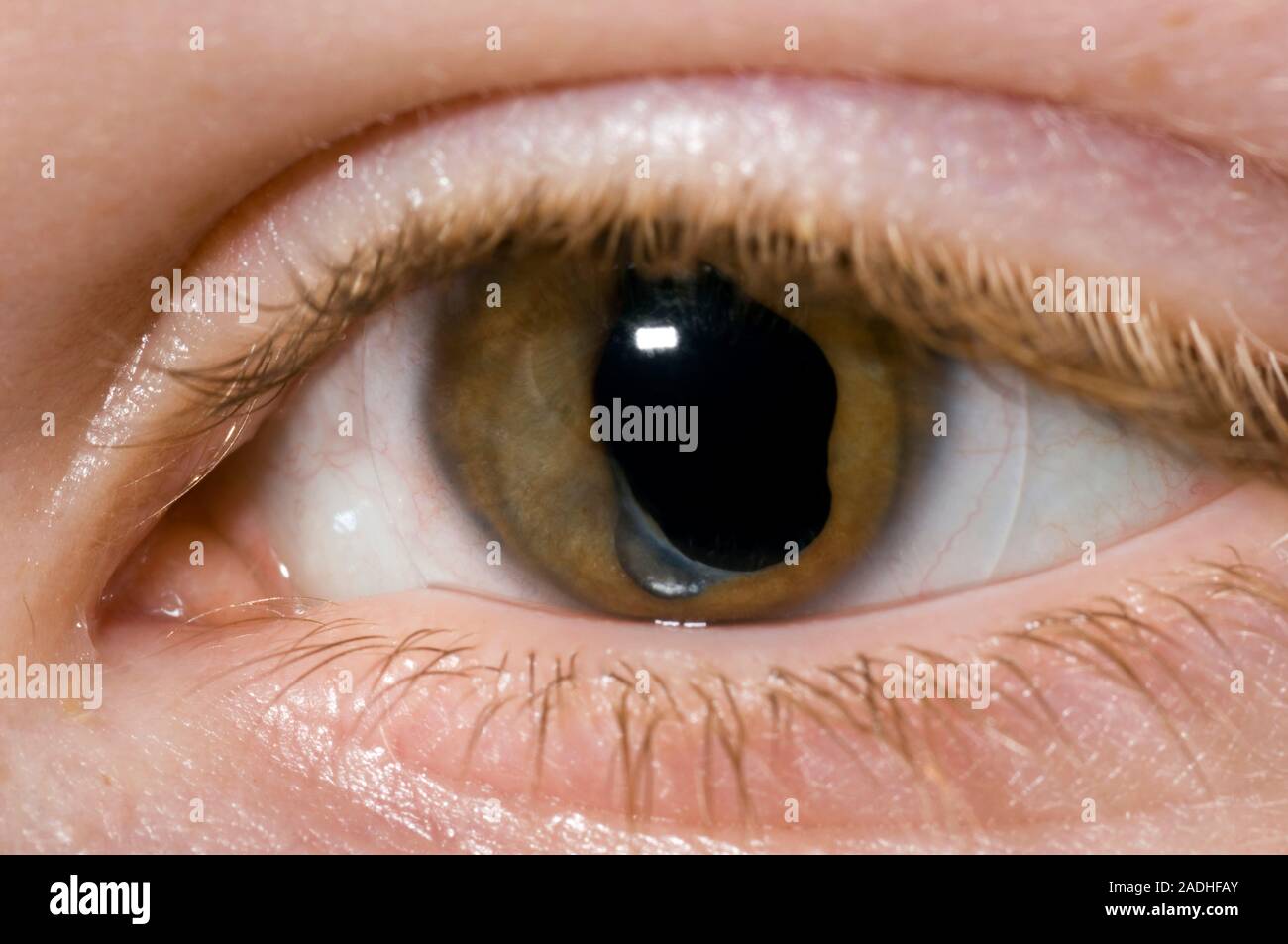 MODEL RELEASED. Distorted pupil (black) of a 12 year old girl after ...