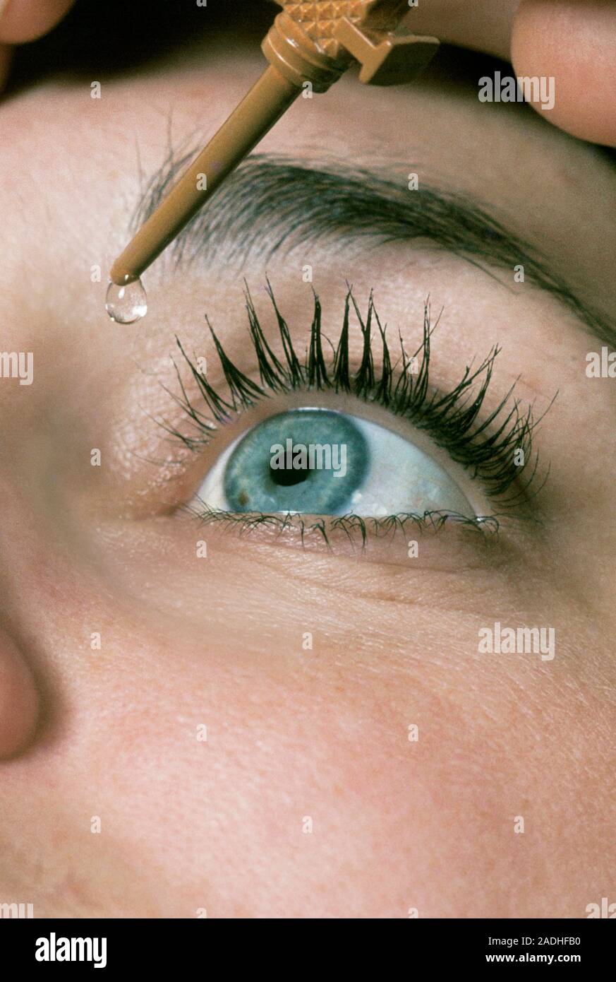 Eye drops. Patient using eye drops to treat an eye condition. Eye drops ...