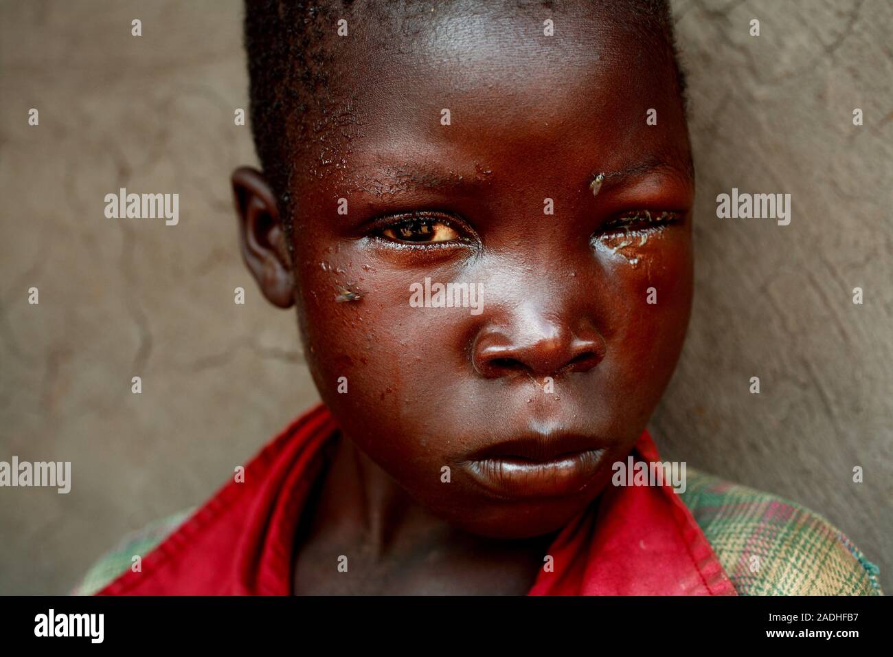 Eye infection. Child with a severe eye infection that has closed up his ...