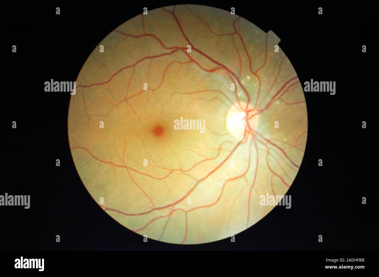 Eye drusen, ophthalmoscope image. This eye has a normal optic disc ...
