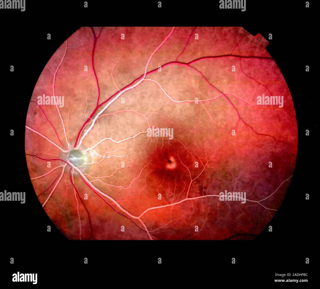 Irritated macula. Ophthalmoscope view of the retina of a patient with ...
