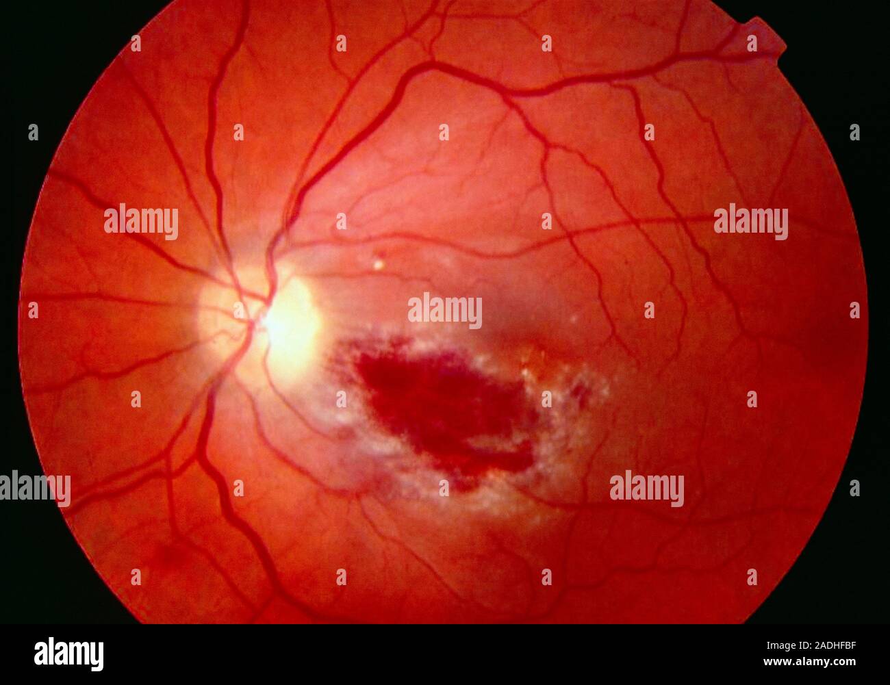 Benign eye tumour. Ophthalmoscope view of the inner eye of a patient ...