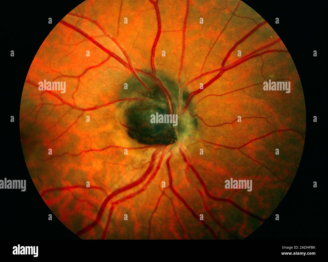 Benign eye tumour. Ophthalmoscope view of a melanocytoma (dark mass) on ...