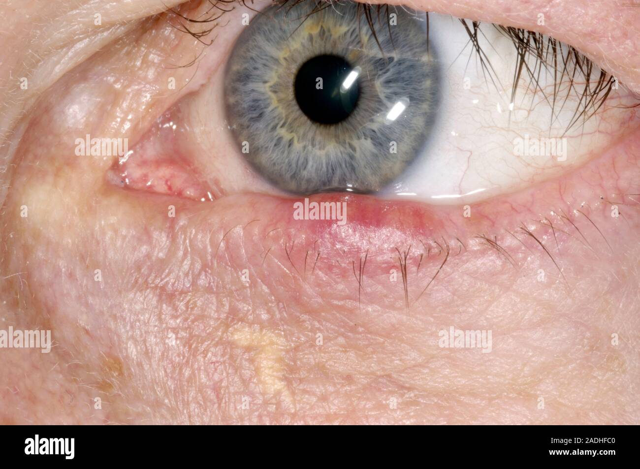 MODEL RELEASED. Eye cyst on the lower eyelid of a 58 year old man. This ...