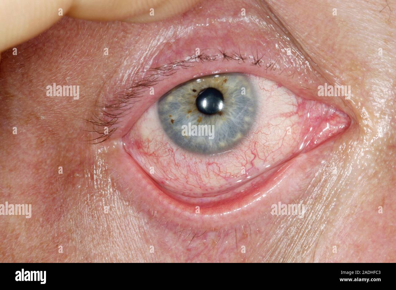 MODEL RELEASED. Corneal abrasion. Bloodshot eye of a 47-year-old man ...