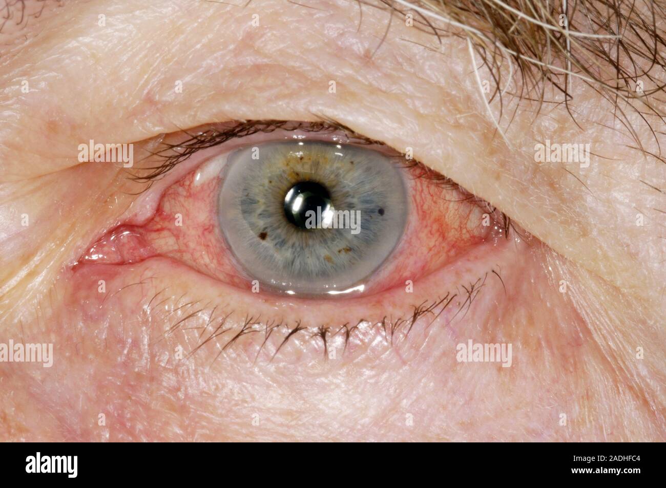 MODEL RELEASED. Inflamed iris. Bloodshot eye of a 77-year-old man with ...