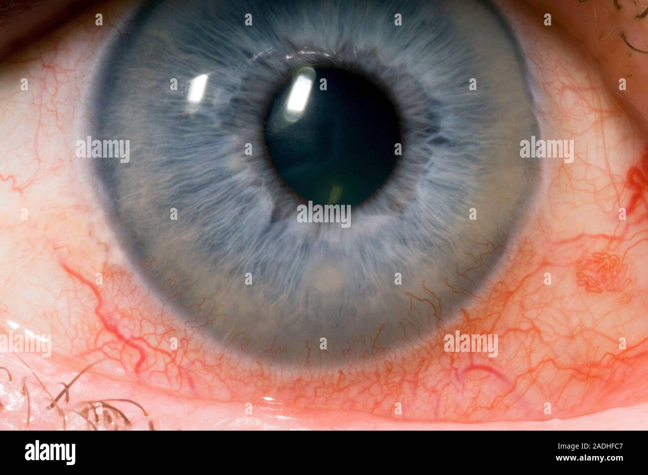 MODEL RELEASED. Inflamed cornea. Bloodshot eye of a 72-year-old woman ...