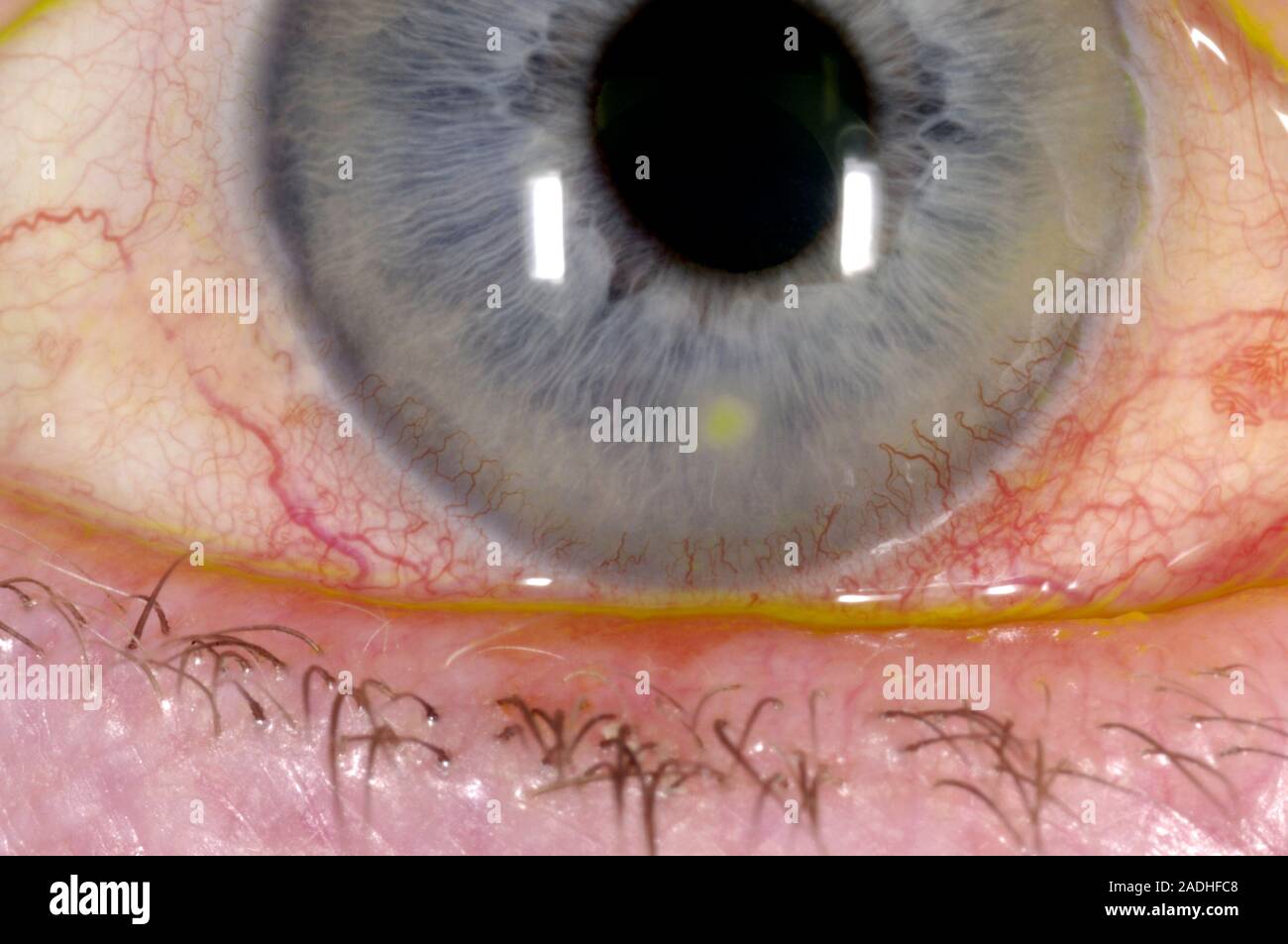 MODEL RELEASED. Inflamed cornea. Bloodshot eye of a 72-year-old woman ...