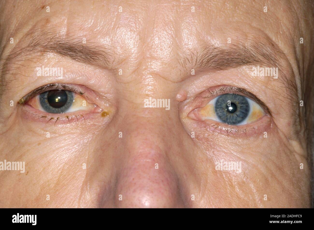 Dilated pupil (left) in the eye of a 57-year-old woman, one week after ...