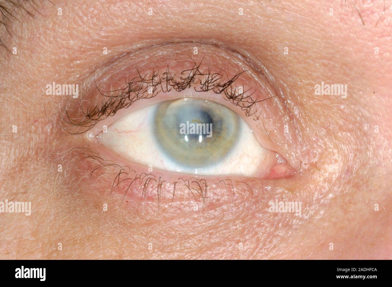 Scarred cornea following an assault. The scarring is the white, cloudy ...